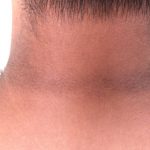 Diabetes And Skin Problems | How Can Diabetes Impact Your Neck ...